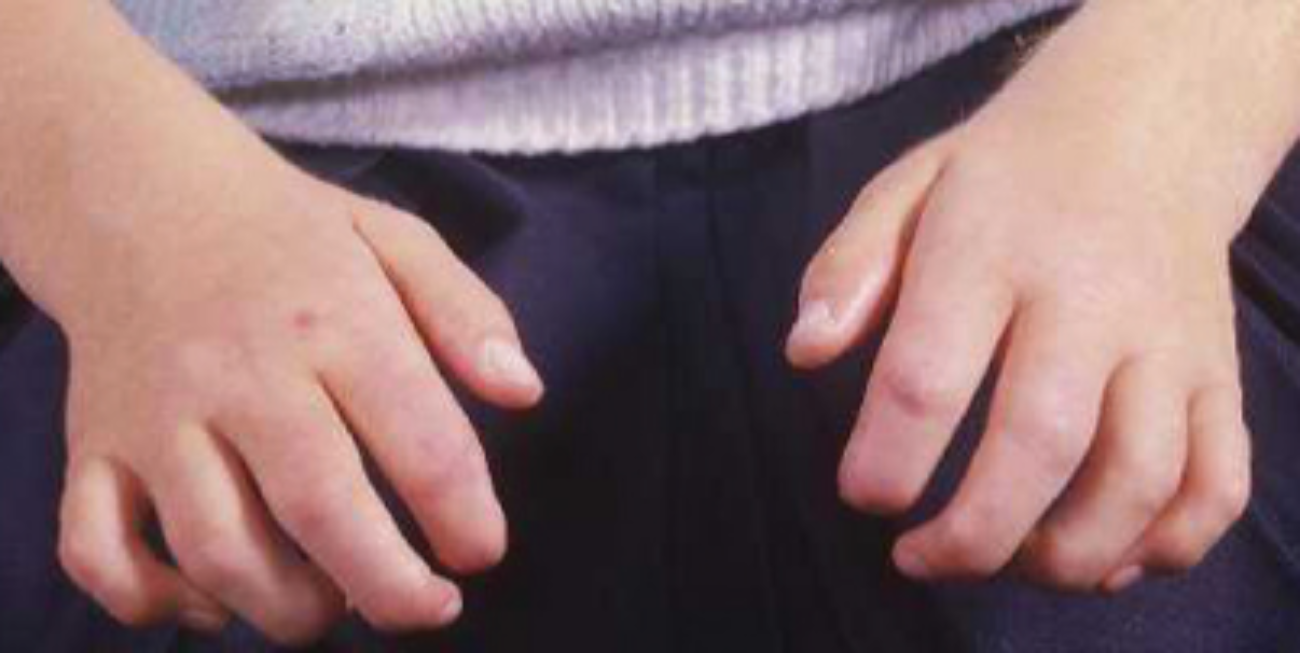 DIFFERENTIATING MPS I